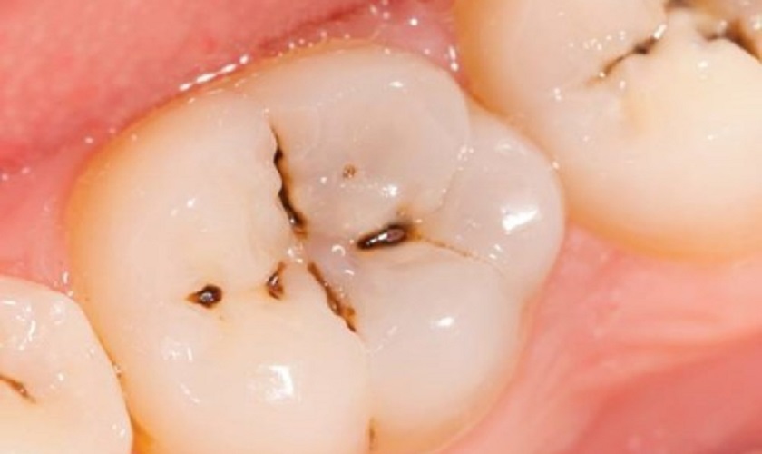 Nguyên nhân răng bị chấm đen là gì? - Nha khoa Sk Dental Clinic