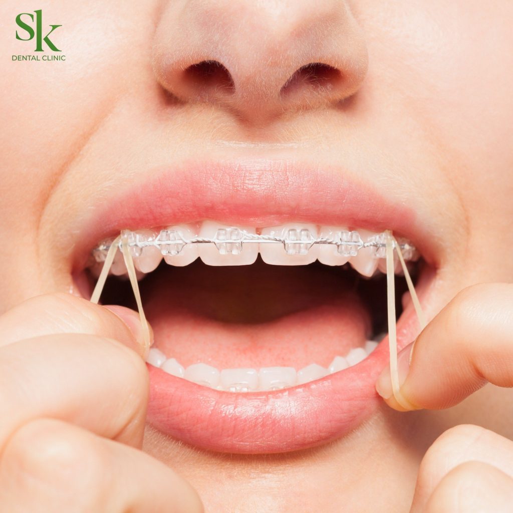 CHUN LIÊN HÀM LÀ GÌ? ĐEO Ở GIAI ĐOẠN NÀO? - Nha khoa Sk Dental Clinic