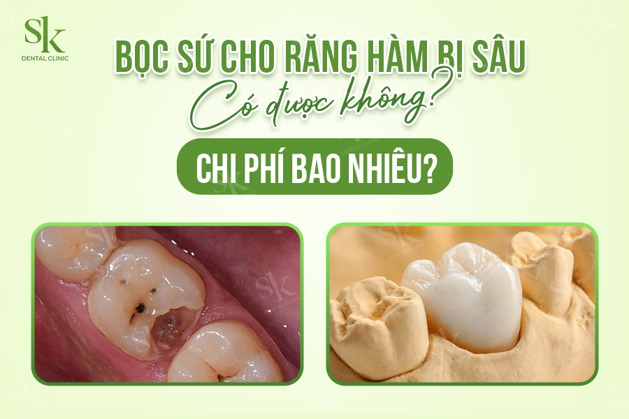 Bọc sứ răng hàm bị sâu: Giá bao nhiêu? Quy trình 6 bước chuẩn chỉnh ...